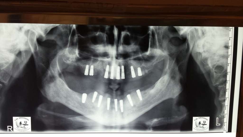 Full bi-maxillary edentulism - Clinical case 18