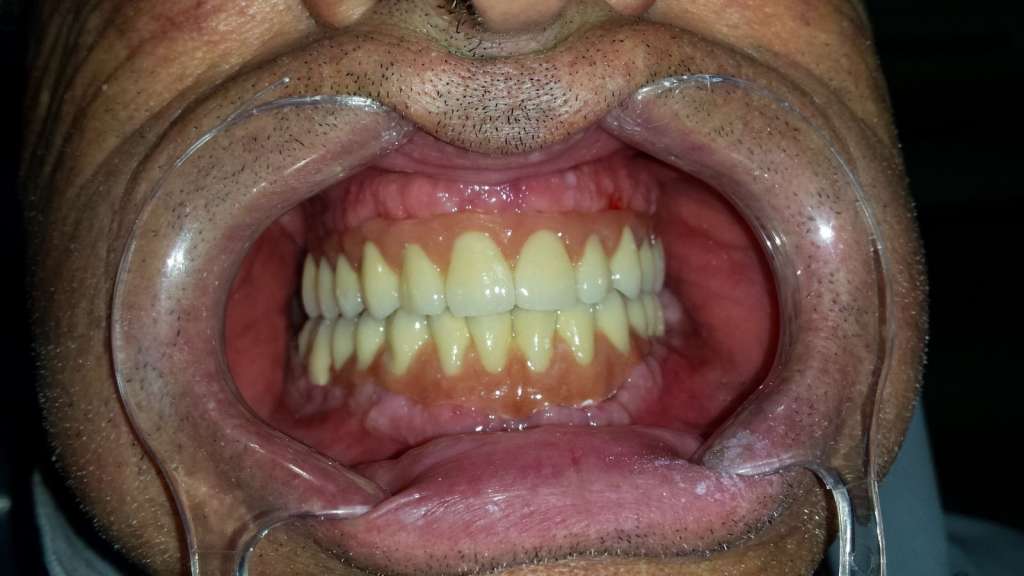 Full bi-maxillary edentulism - Clinical case 18