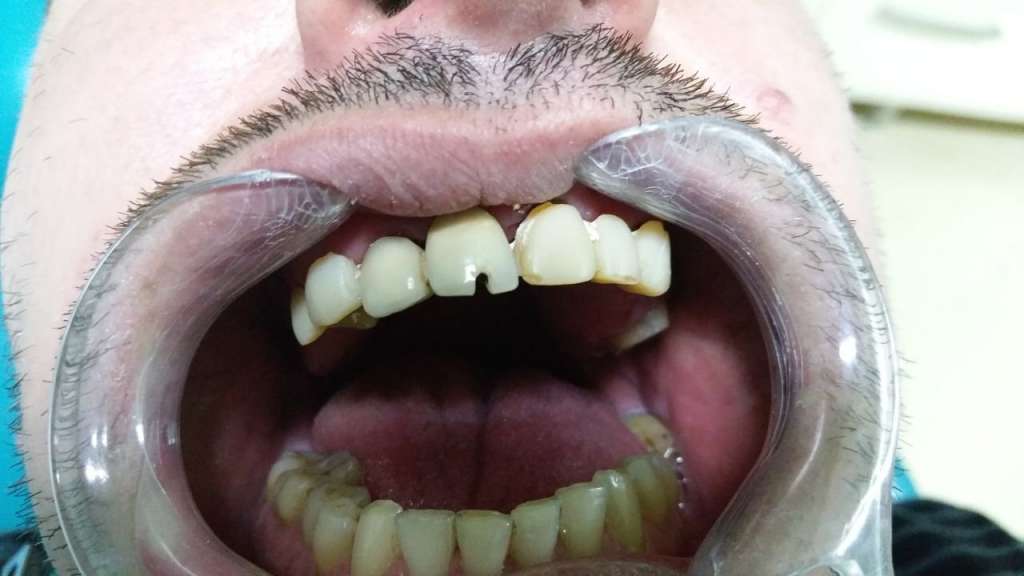 Fixed metal-ceramic dental crown - Clinical case 29