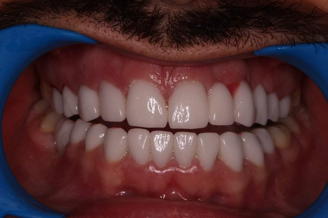 EMax dental crowns - Clinical case 39